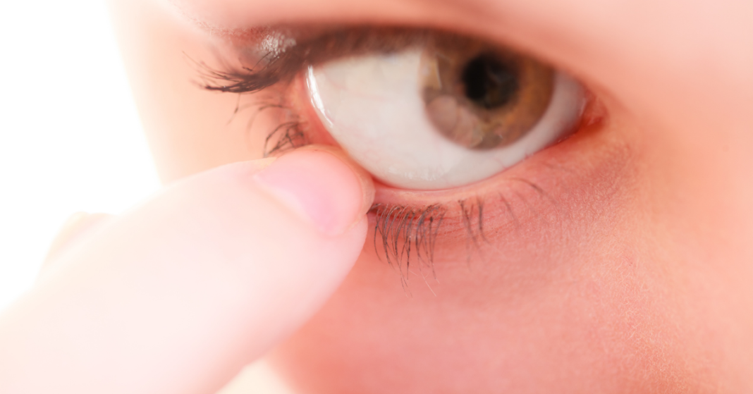 Ingrown Eyelash - Causes and How To Treat It?
