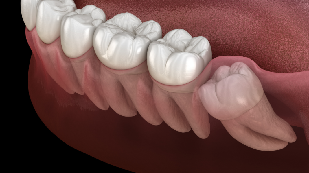 Gum Hurts Where Wisdom Tooth Was Removed Years Ago | Exercise Daily