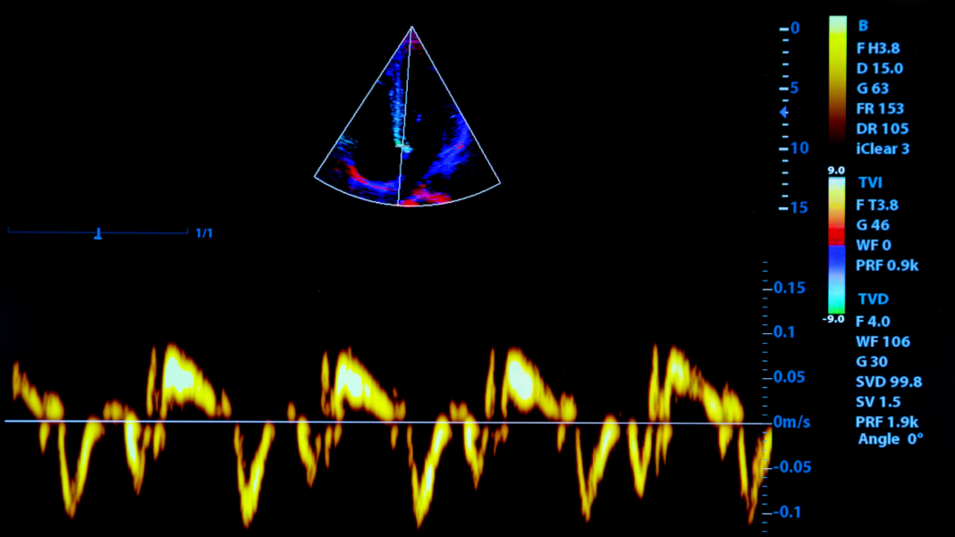Best Diet For PVCs & its Management | Exercise Daily
