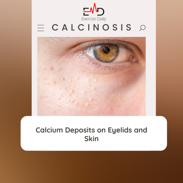 Calcium Deposits on Eyelids and Skin | Exercise Daily