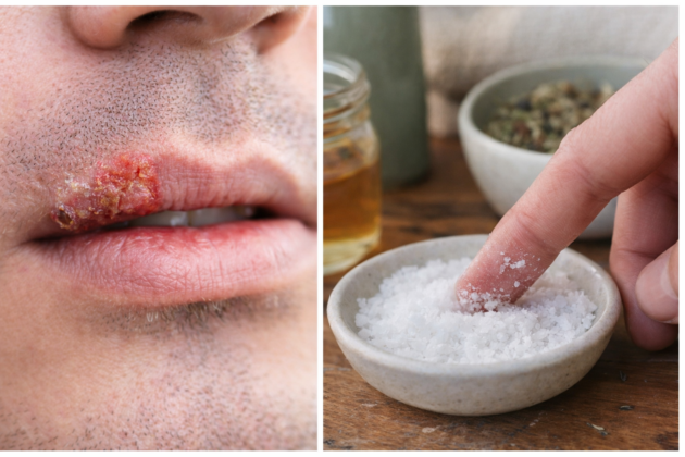 Cold Sore Healing Time: Can Salt Speed Recovery?